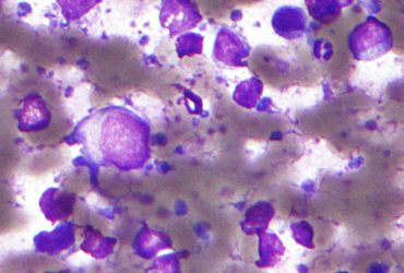 New CAR T-Cell Therapy Breyanzi Approved for R/R B-Cell Lymphoma