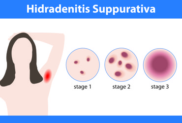 Cosentyx Improves Symptoms of Hidradenitis Suppurativa