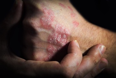 FDA Approves Sotyktu for Patients With Moderate to Severe Plaque Psoriasis