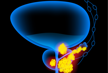 Akeega Plus Prednisone Approved for BRCA-mutated mCRPC