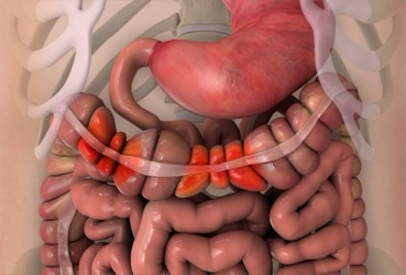 FDA Approves Zymfentra for IBD