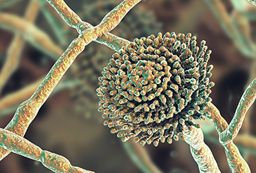 Osteomyelitis Aspergillus Rare Treatable fungal infection